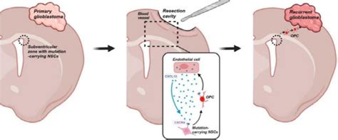 Determining The Cause Of Recurrence Of Malignant Brain Tumor Glioblast