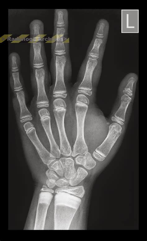 Radiology Archives Μολυβδίαση Dense Metaphyseal Band Sign