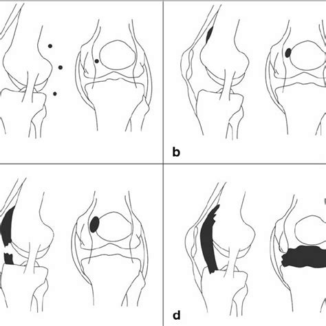 X Classification System For Ho Of The Knee Joint A Grade 1 Ho B Grade Download Scientific
