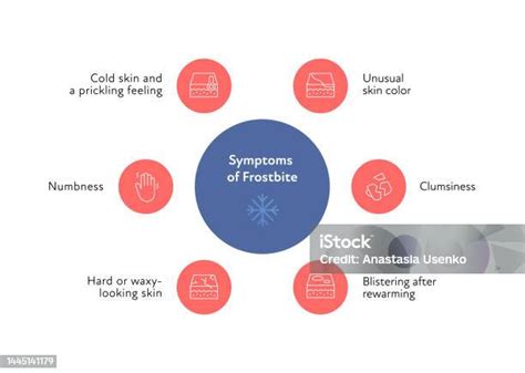 동상 및 저체온증 건강 관리 인포그래픽 컬렉션 벡터 평면 디자인 의료 그림입니다 아이콘이 있는 빨간색과 파란색 원입니다 텍스트가있는 동상 증상의 다양한 아이콘 동상에 대한