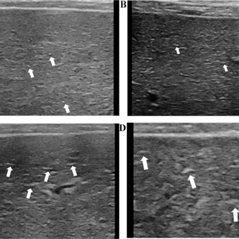 The Ultrasound Findings Of The Liver Surface A Smooth B Mild Download Scientific Diagram
