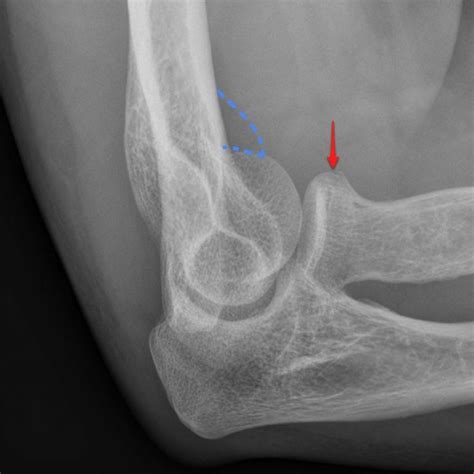 Radial Head Fracture Radiology Case Radiology