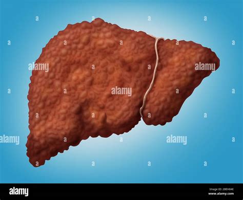 Regenerative Nodules Hi Res Stock Photography And Images Alamy