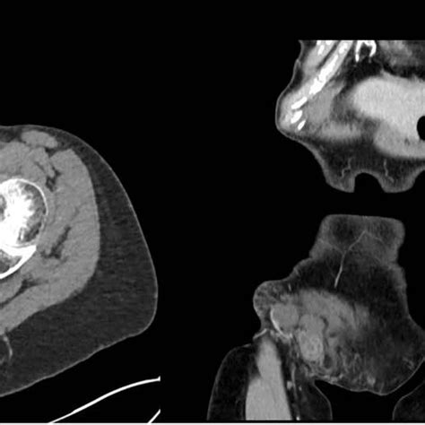 CT Scan Images Of A 68 Year Old Woman Who Presented With Acutely Download Scientific Diagram