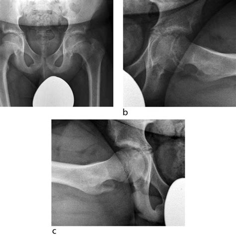For The Modified Dunn Procedure A Patients Are Positioned In The