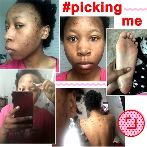 Dermatillomania Aka Skin Picking Disorder Excoriation Excoriation