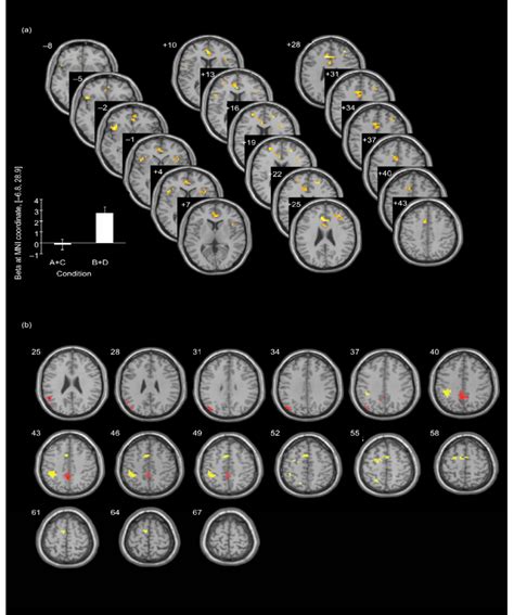 imaging results a analysis of the statistical parametric mapping