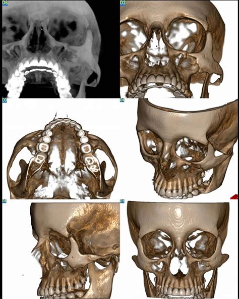 Samareh Abbassi On Linkedin Left Zmc Fracture