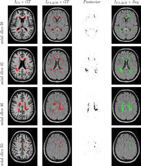 Figure 3 From Spatial Decision Forests For Ms Lesion Segmentation In