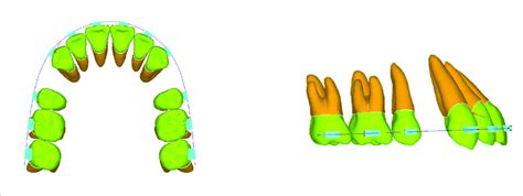 Finite Element Modeling Of Teeth Brackets And Archwire Download
