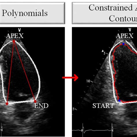 The Aps Method For The Endocardial Boundary Of The Lv Wall Extraction Download Scientific