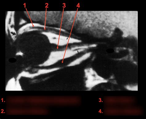 Sagittal Mri Of Eye Diagram Quizlet