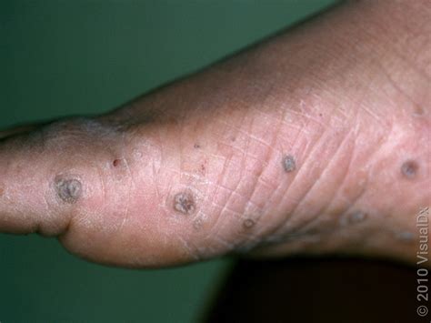 Warts On Feet Pictures
