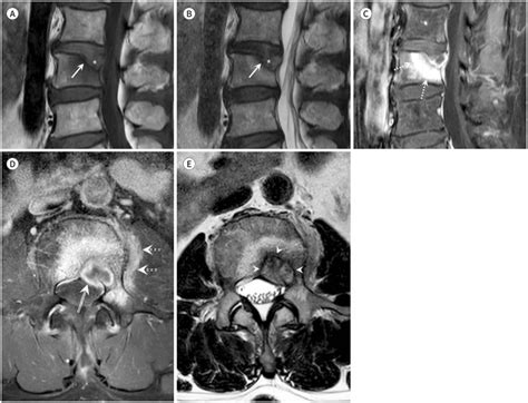 Pathophysiology And Mri Findings Of Infectious Spondylitis And The