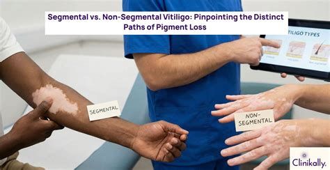 Segmental Vs Non Segmental Vitiligo Differences And Treatment