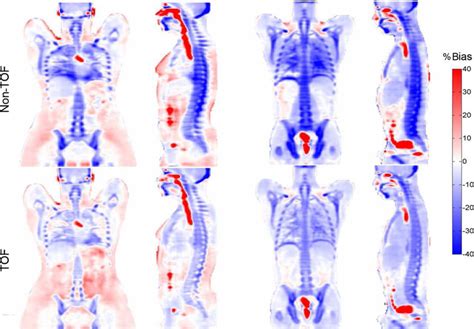 Potential Impact Of Tof On The Accuracy Of The Mr Based Attenuation