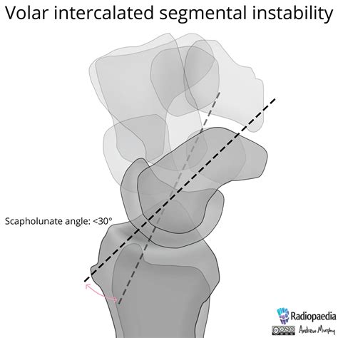 Filenormal Wrist Alignment Dorsal And Volar Intercalated Segmental