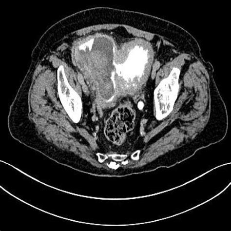Suspicious Lesion Inside A Large Bladder Diverticulum Download Scientific Diagram