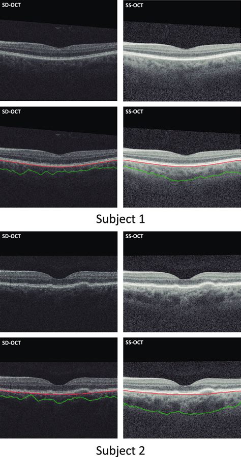 two examples of subjects in whom the proposed choroidal segmentation of