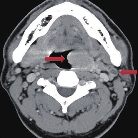 About 28×20 Cm Sized Protruding Mass Is Found In The Left Tonsil The