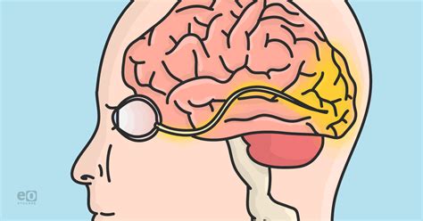 Demyelination Differentiation When Its Not Multiple Sclerosis