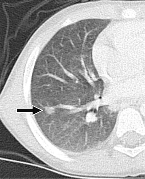 Follicular Bronchiolitis On Computed Tomography Ct In The Setting Of