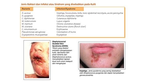 Materi Infeksi Kulit Oleh Bakteri 1 Pdf