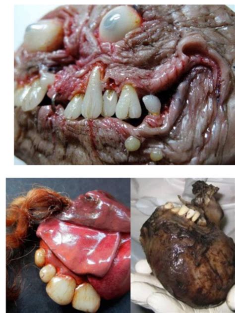¿qué Es Un Teratoma El Raro Tumor Al Que Le Puede Salir Dientes Cabello Y Hasta Huesos Infobae