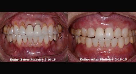 Receding Gums Treatment Gum Recession Causes Reversal And Treatment