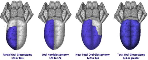 Surgical Management Of Oral Cancer Dental Clinics