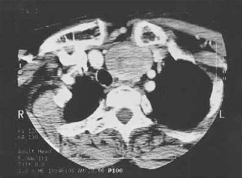 Ectopic Cervical Thymoma Semantic Scholar