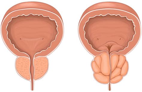 Prostate Adenoma Myths And Their Exposure