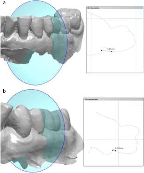 Noncarious Cervical Lesions Nccl Evaluated Using The 2d Download