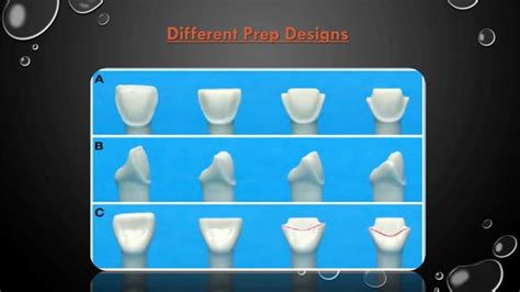 Partial Coverage Restorations Pdf