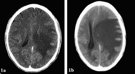 Brain Ct Images Showing Evolution Of Cryptococcoma 1a Left The
