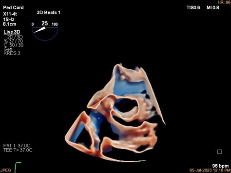 Philips New Mini 3d Tee Ultrasound Transducer Receives Fda 510 K