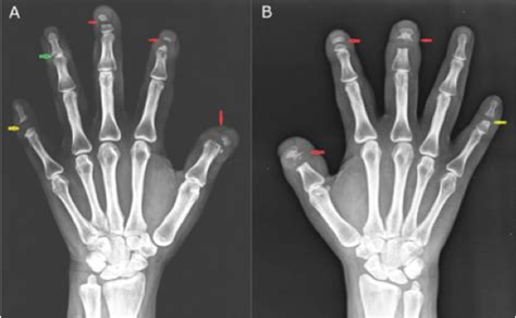 A New Way To Reverse Bone Loss Finding Normality From Abnormality