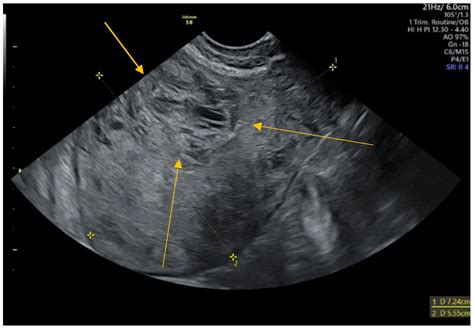Retained Placenta Percreta With Acquired Uterine Arteriovenous