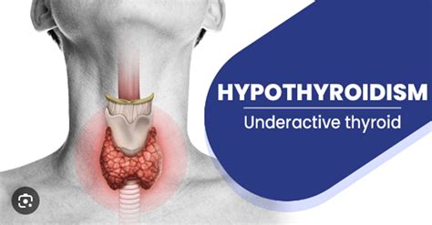 Hypothyroidism Underactive Thyroid Symptoms And Causes