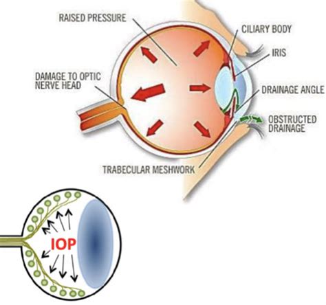 Glaucoma Flashcards Quizlet Glaucoma Flashcards Quizlet