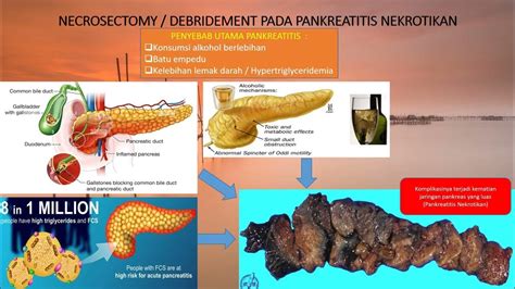 Necrosectomy Debridement Pada Pankreatitis Nekrotikan Youtube