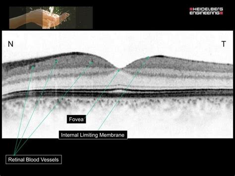 Spectralis Oct Normal Anatomy And Systematic Interpretation Pdf Eye And Vision Conditions