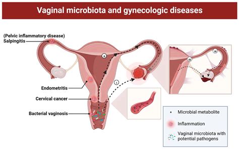Potential Role Of Vaginal Microbiota In Ovarian Cancer Carcinogenesis
