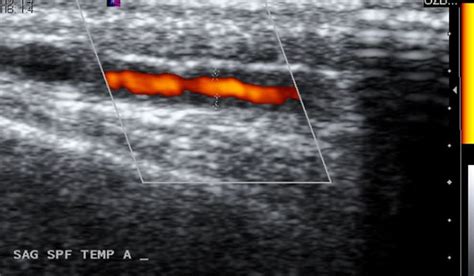 Temporal Artery Ultrasound