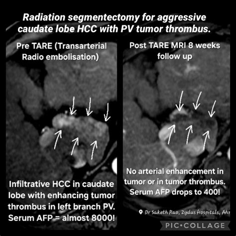 Saketh Rao On Linkedin Interventionalradiology Sirtex Tare Radiationsegmentectomy