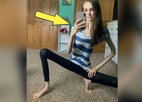 40 Individuals With Unique Genetic Features Trendy Matter Genetics Different Colored Eyes