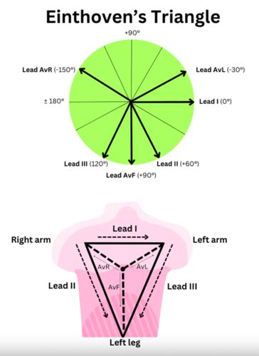 ECG Axis Deviation Flashcards Quizlet