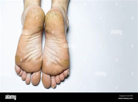 Punctate Keratolysis On The Feet The Pitted Keratolysis On Foot Of Man