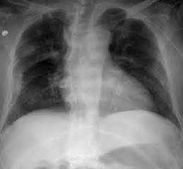 PICC Into Hepatic Veins IV Therapy Net