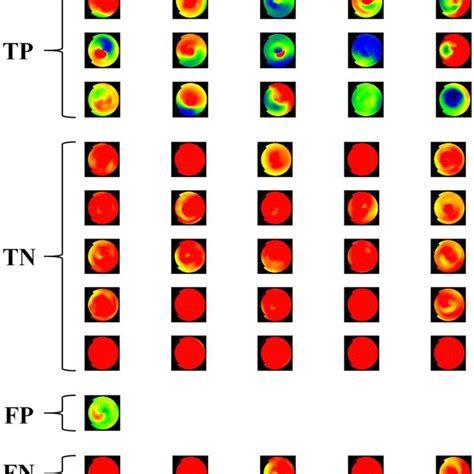 Visualization Of Polar Maps Classified As True Positive Tp True Download Scientific Diagram